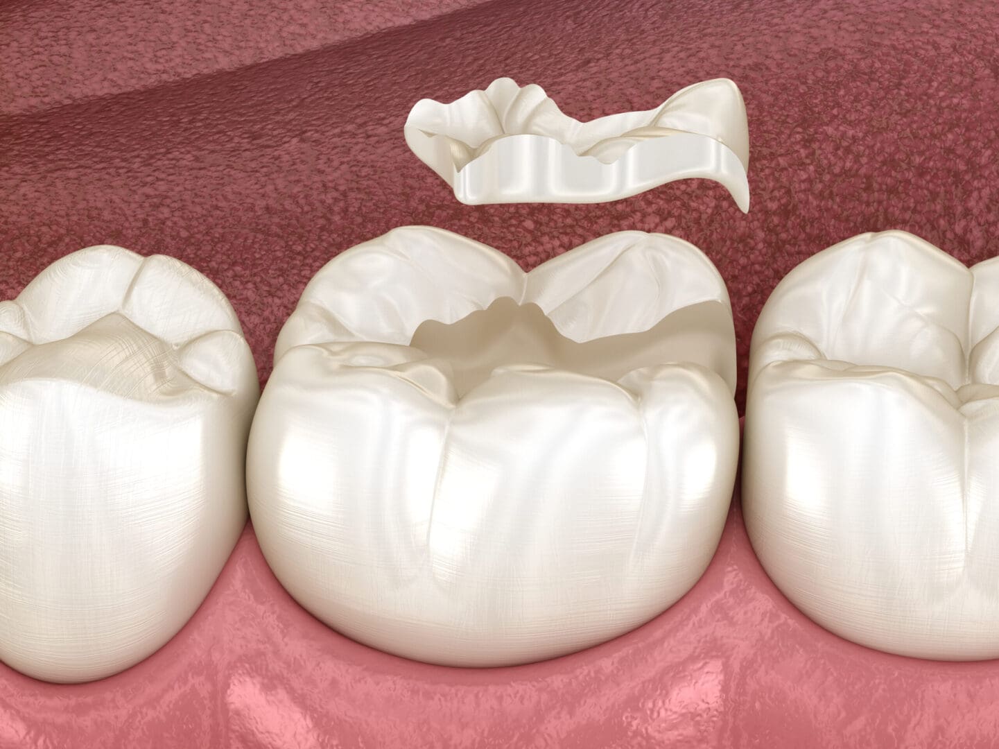 Les prothèses dentaires esthétiques | Smile Implant